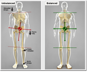 Short Leg Syndrome or Leg Length Inequality - Levin and Chellen ...